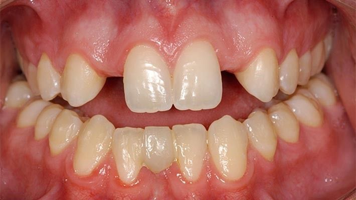 En qué consiste la agenesia dental y sus posibles soluciones