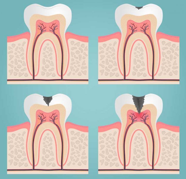 Pulpectomía, la endodoncia infantil | Qué es y cuando se realiza